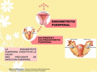 INFECCIÓN PUERPERAL | PPT
