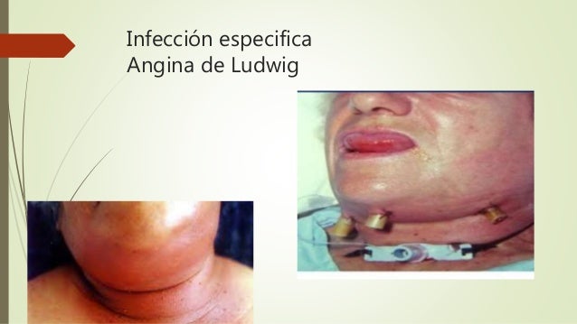 Infeccion de espacios profundos cuello