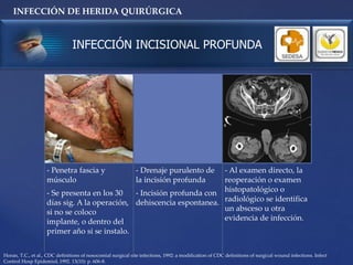 Infeccion de herida quirurgica
