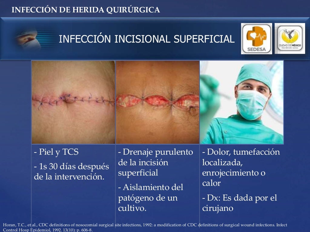 Infeccion de herida quirurgica