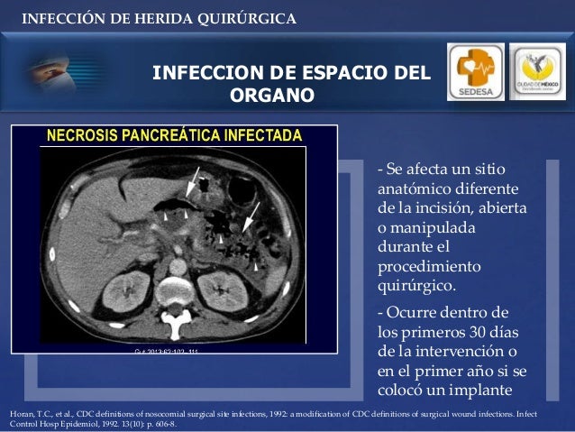 Infeccion de herida quirurgica