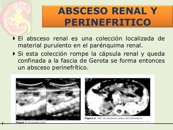 Infeccion De Vias Urinarias