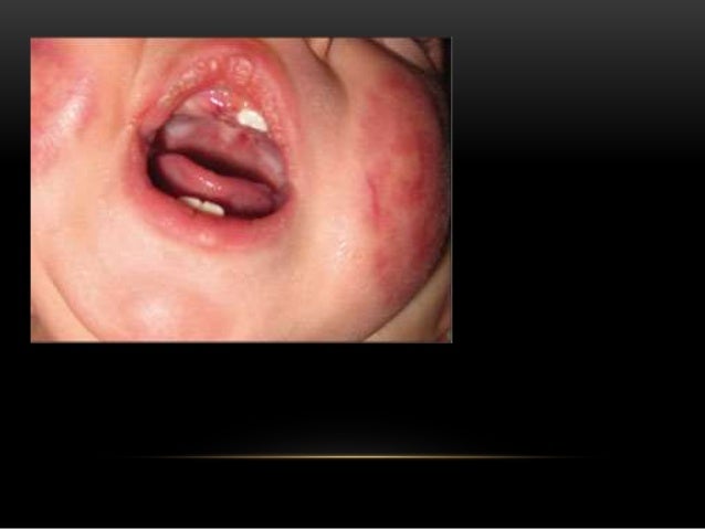 Infecciones por Haemophilus influenzae tipo b