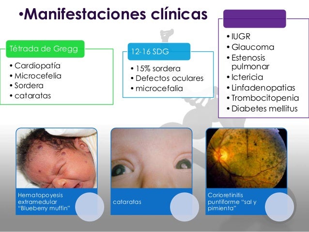 Infecciones congenitas torches
