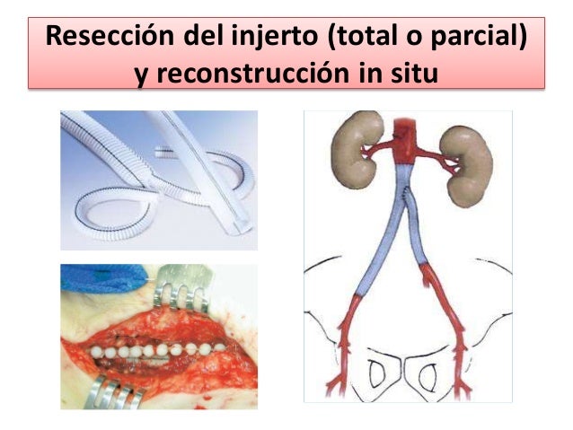 Infecciones de injerto vascular