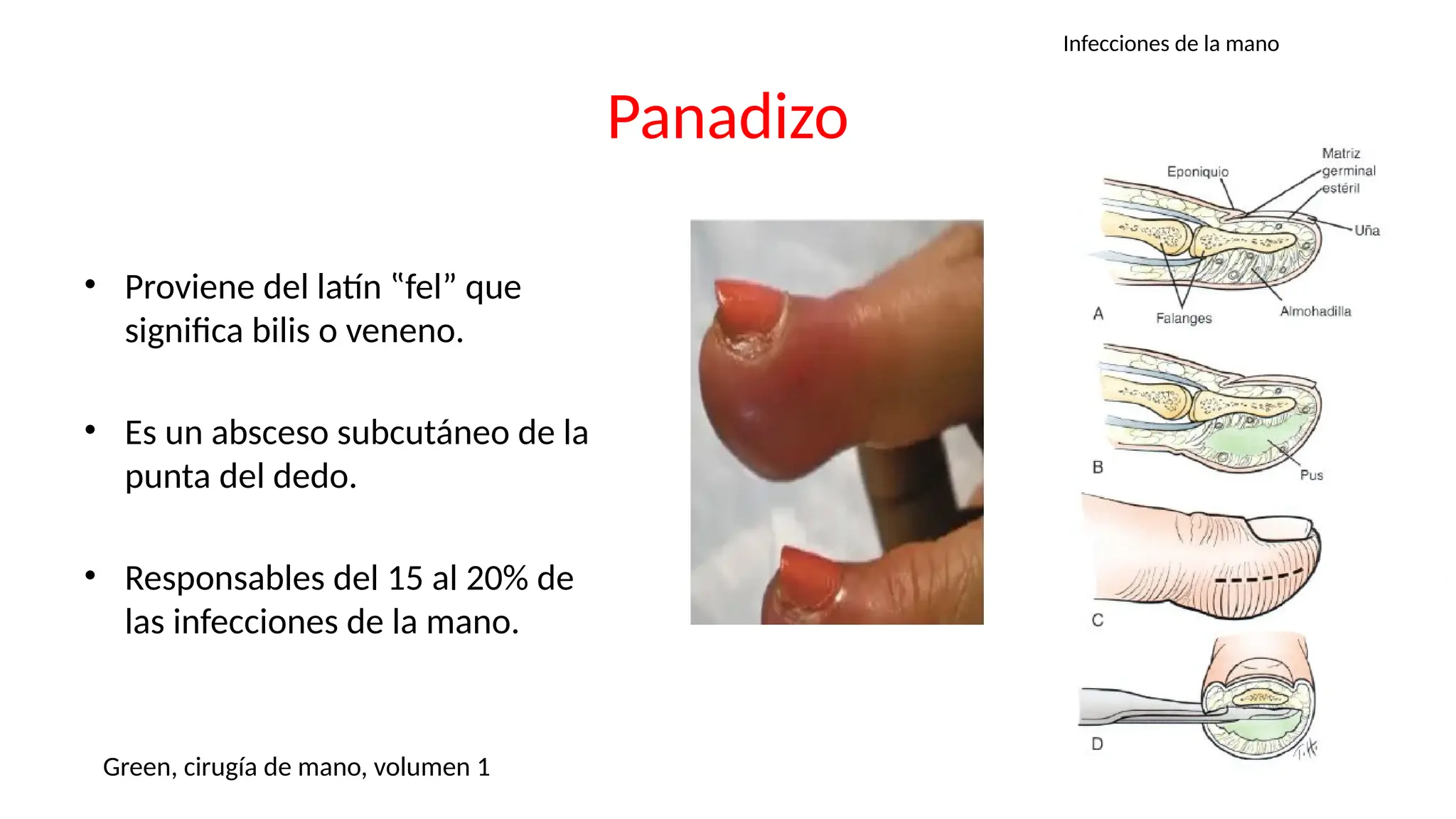 Infecciones de la mano en pacientes de venezuela | PPT