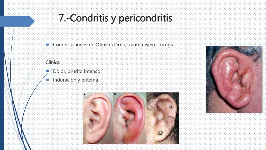Infecciones del oido externo, otitis externa aguda
