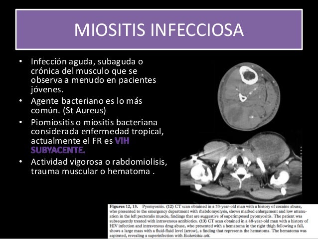 Infecciones del sistema musculoesqueletico