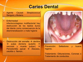 Infecciones dentales | PPTX