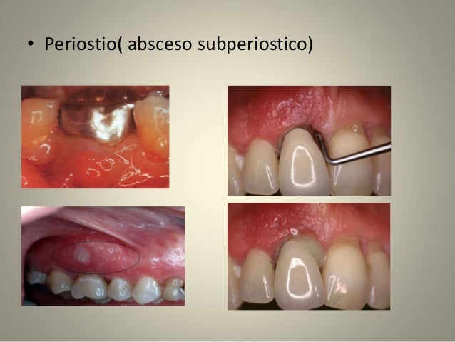 Infecciones dentales