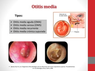 Infecciones de oido | PPTX