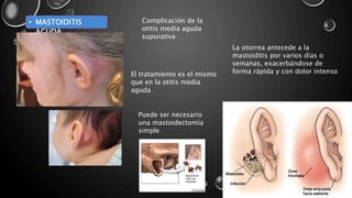 Infecciones de oido medio. Otorrinolaringologia. | PPTX