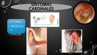 Infecciones de oido medio. Otorrinolaringologia. | PPTX