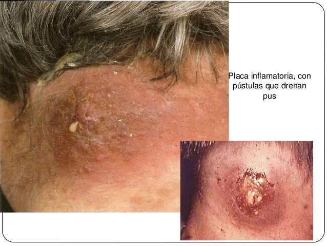 Infecciones de piel por bacterias y virus