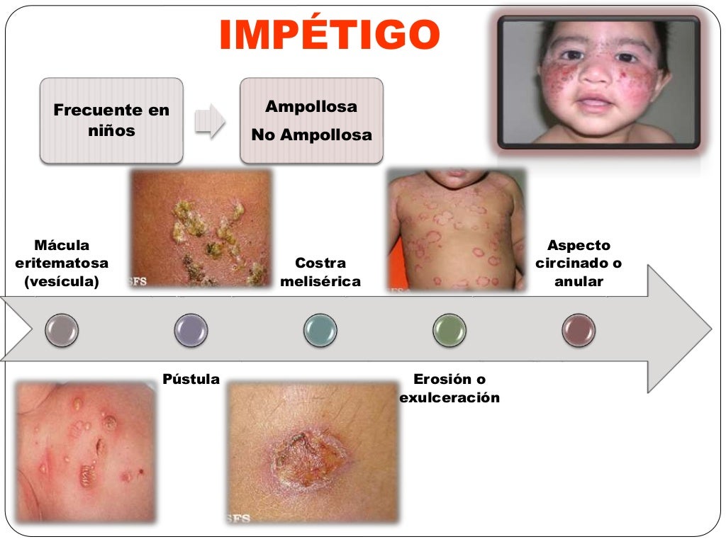 Infecciones De Piel Por Bacterias Y Virus - vrogue.co