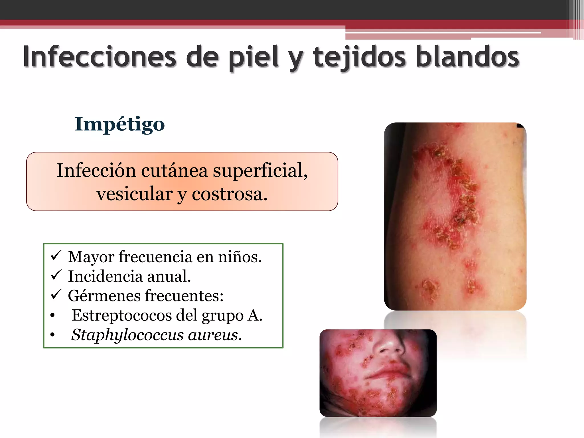 Infecciones de piel, tejidos blandos | PPTX