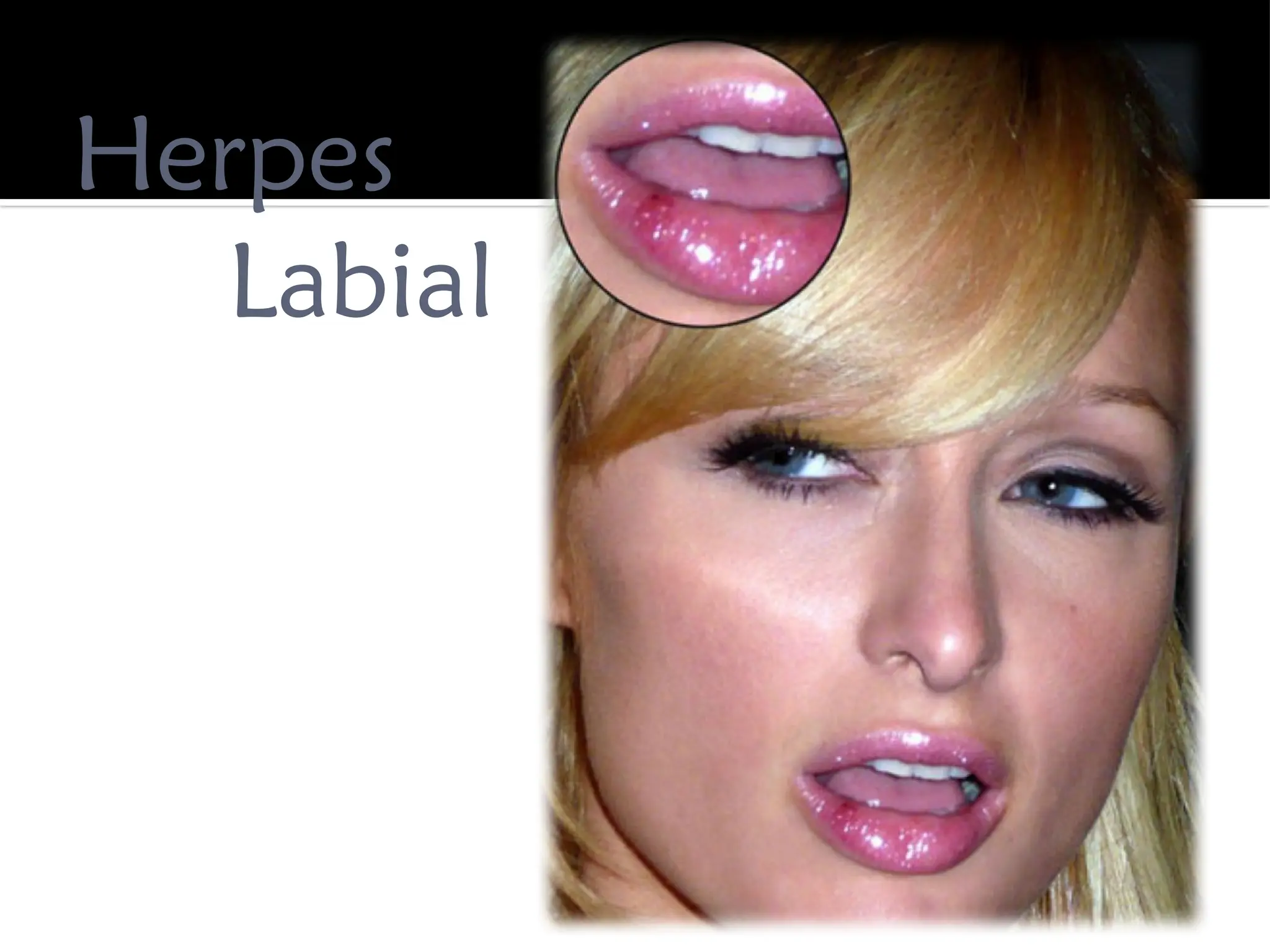 Infeccionesdetransmisionsexual Instituto Ilavepptx