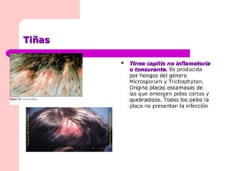 Infecciones e infestaciones del cabello y cuero cabelludo | PPS