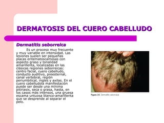 Infecciones e infestaciones del cabello y cuero cabelludo | PPS