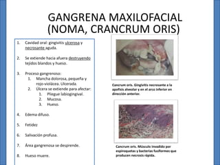 Infecciones mayores de la boca, las mandíbulas y tejidos periorales | PPTX