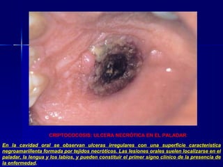 INFECCIONES MICOTICAS ORALES | PPT