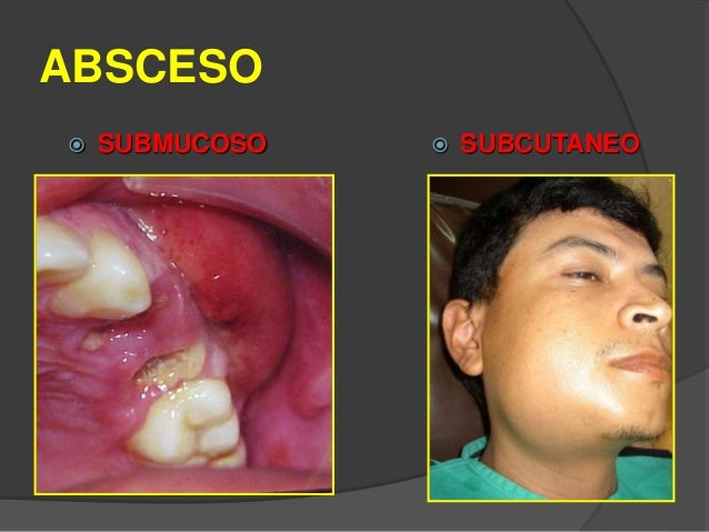 Infecciones odontogénicas