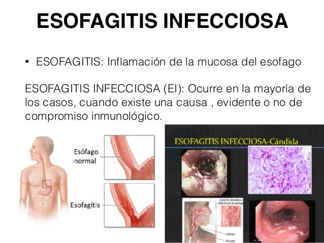 ESOFAGITIS INFECCIOSA
