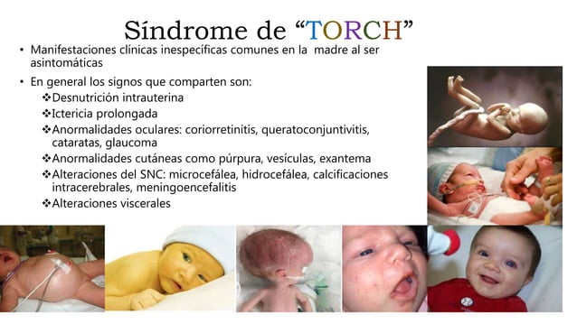 Infecciones perinatales (INTRAUTERINAS) Sx TORCH PEDIATRIA