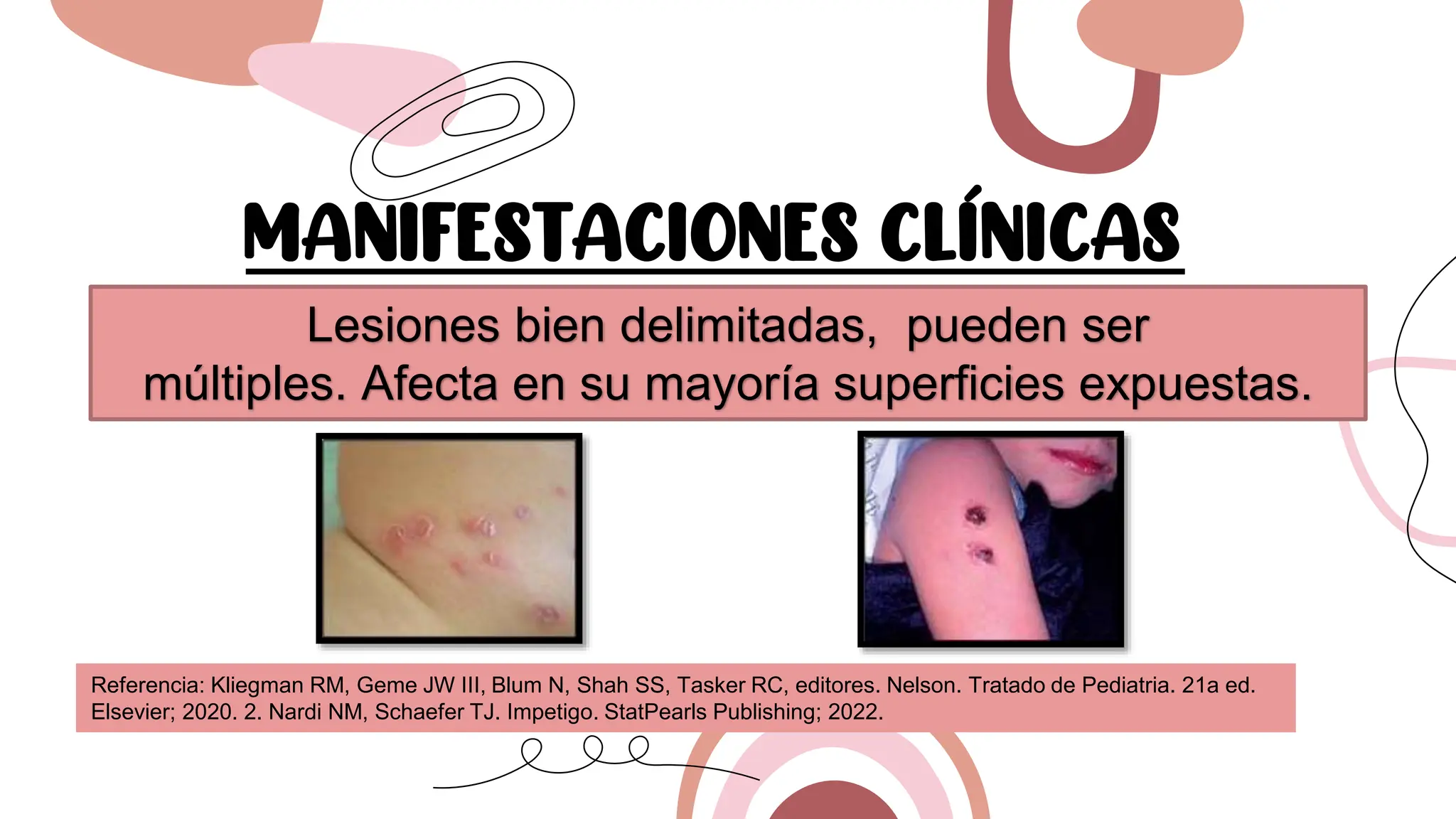 Infecciones de la piel y partes blandas(Impétigo, celulitis, erisipela ...