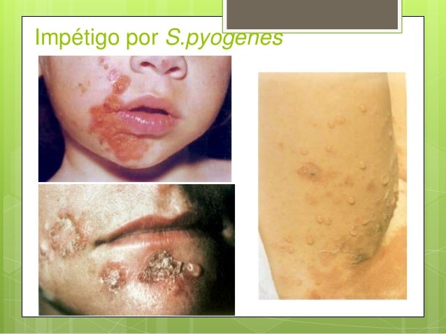 Infecciones piogenas