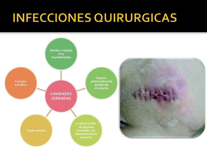 Infecciones quirurgicas