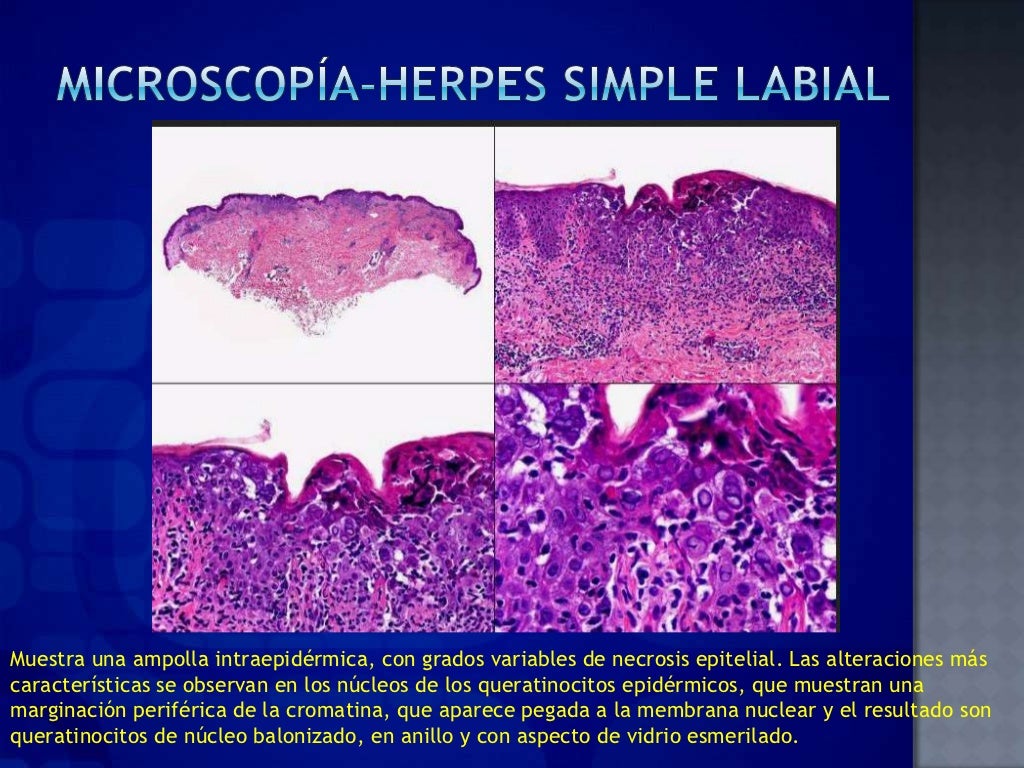 Virus Herpes Fisiopatologia De La Infeccion Clinica E Histologia