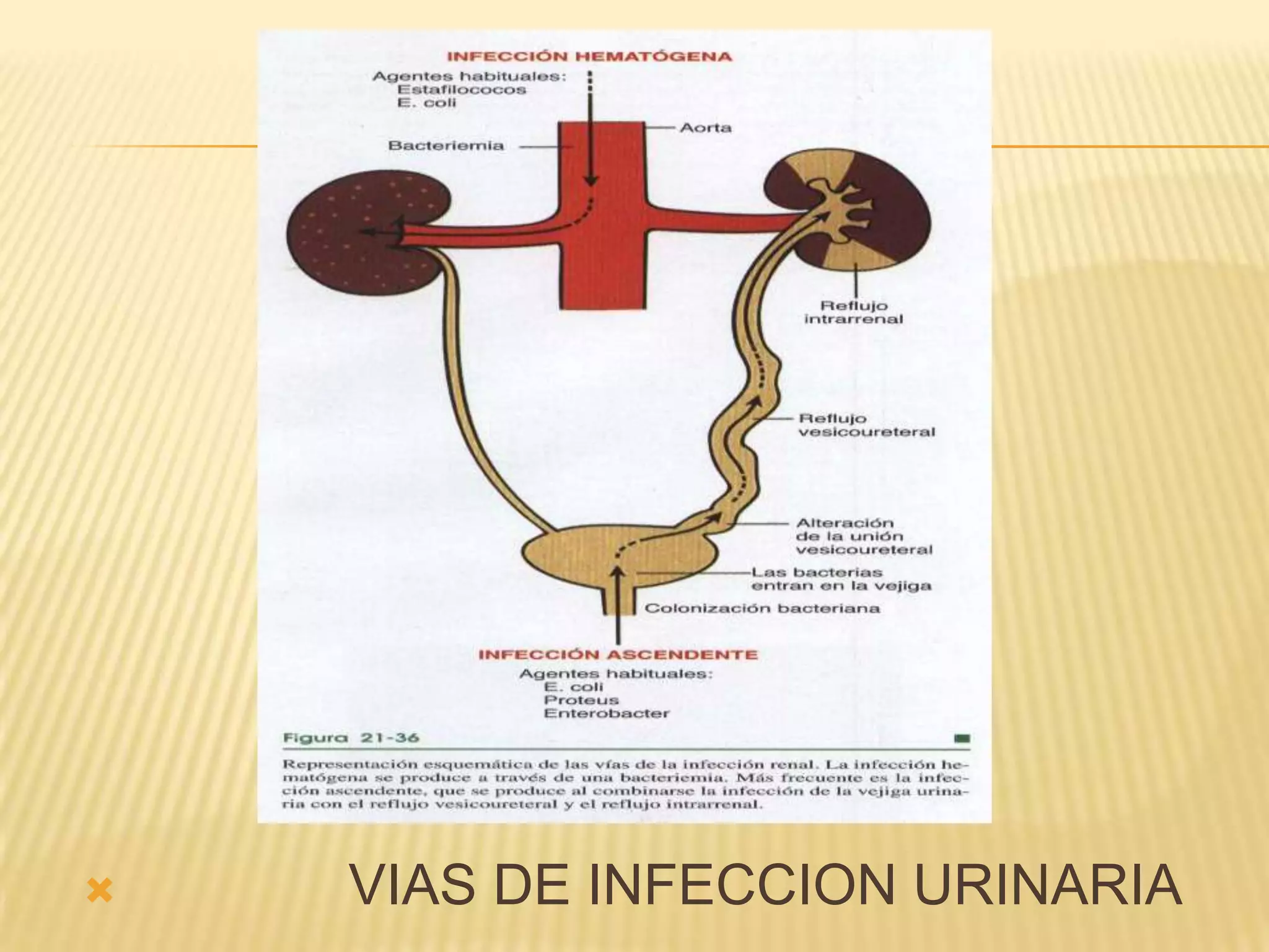 Infeccion Urinaria | PPTX