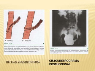 Infeccion Urinaria | PPTX