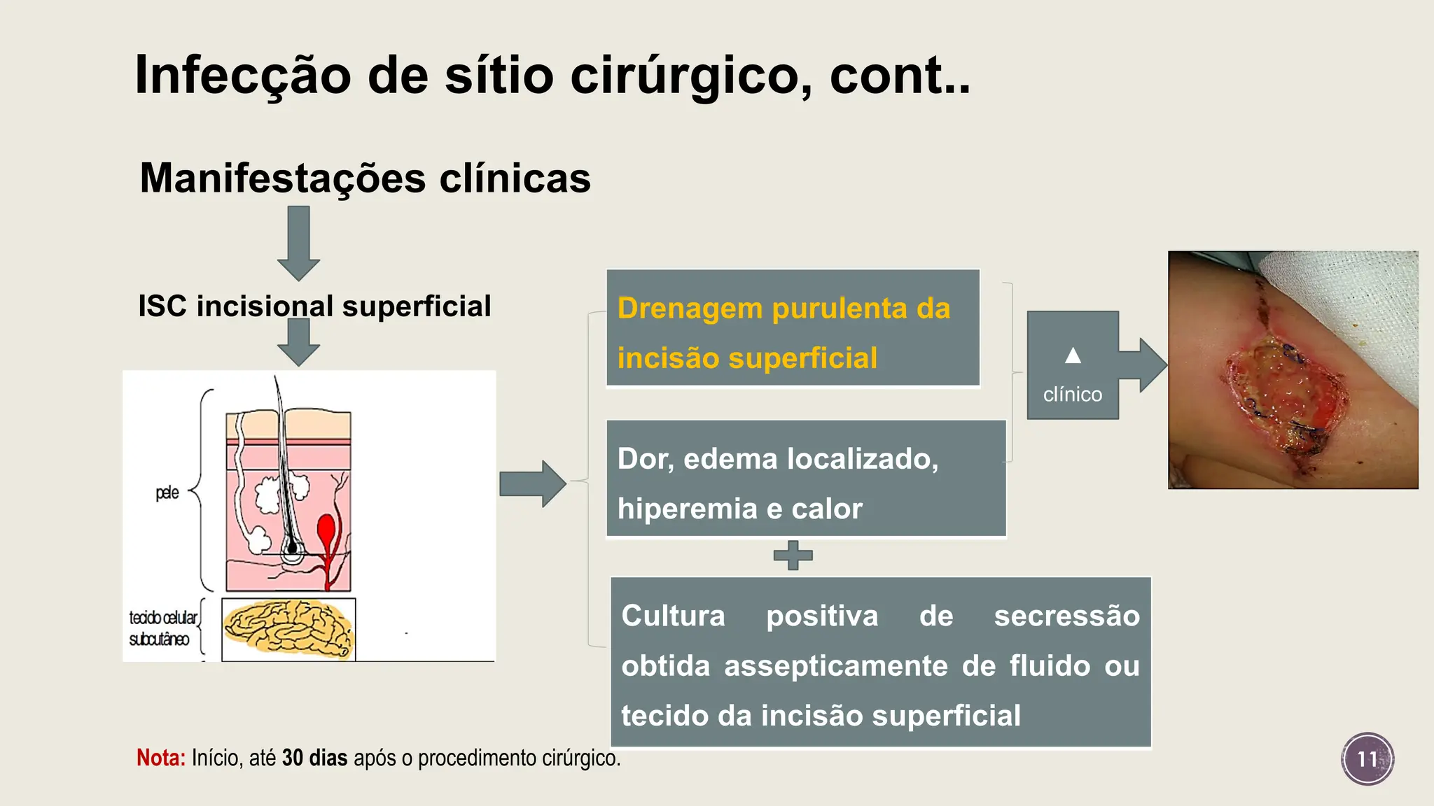Infecções Cirurgicas, diagnóstico e tratamento.pptx