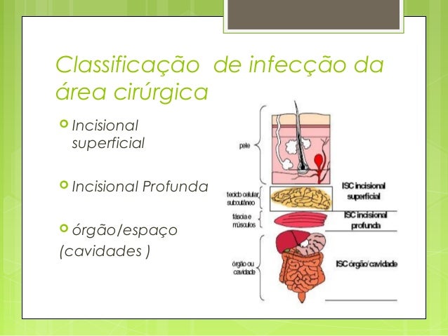 Infecção do sítio cirúrgico slide
