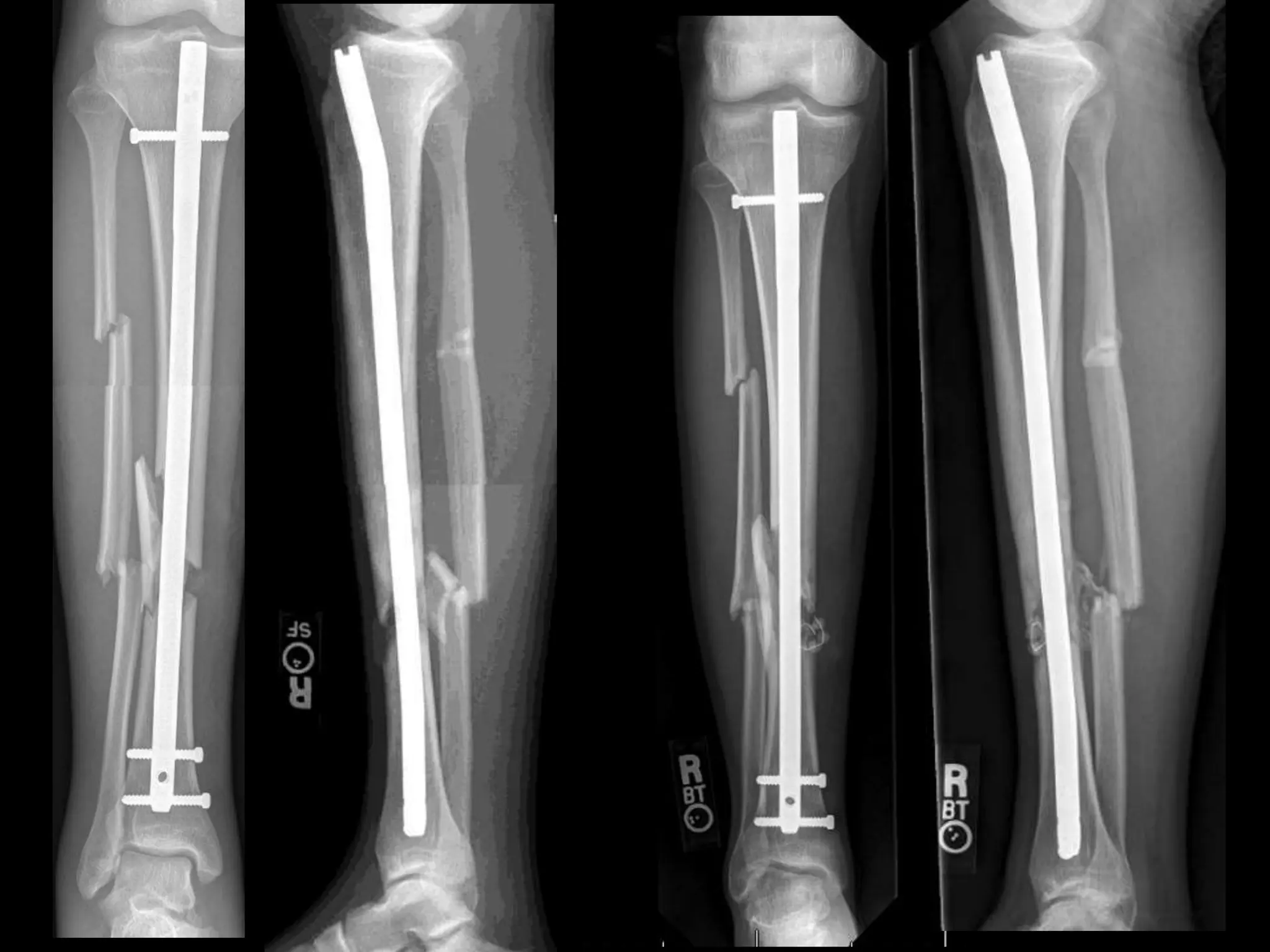 Infected Fractures - Principles, com.ppt