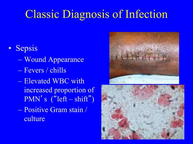 Infected Fractures - Principles, com.ppt | Infectious Diseases ...
