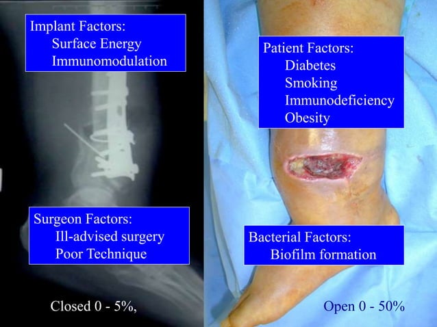 Infected Fractures - Principles, com.ppt | Infectious Diseases ...