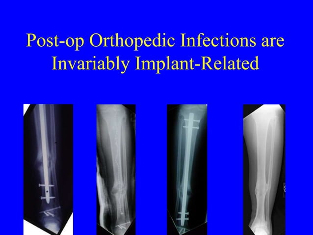 Infected Fractures - Principles, com.ppt | Infectious Diseases ...