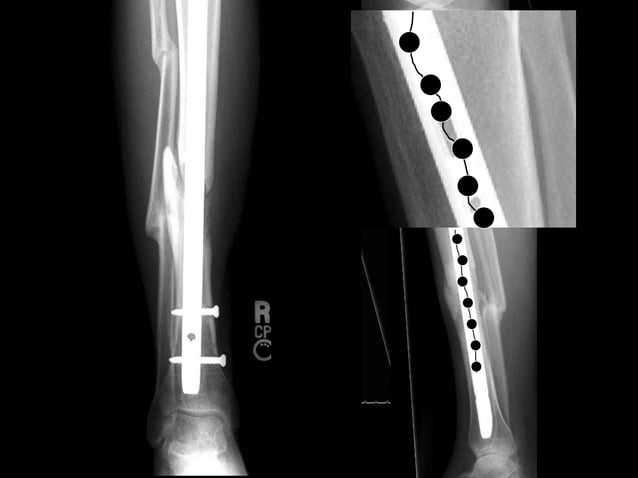 Infected Fractures - Principles, com.ppt | Infectious Diseases ...