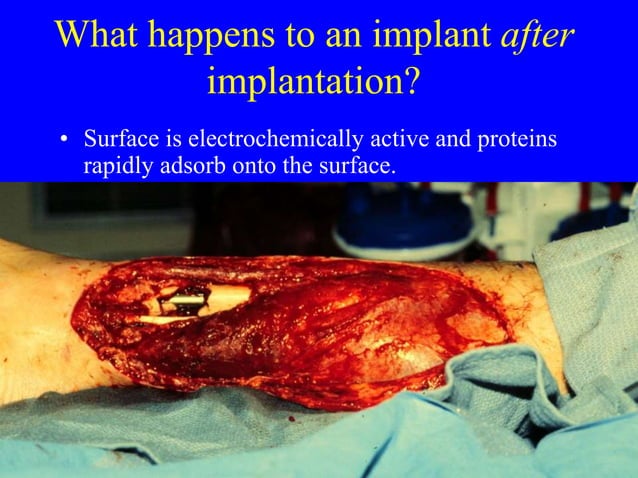Infected Fractures - Principles, com.ppt | Infectious Diseases ...