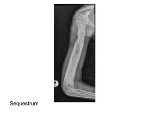 Osteomyelitis X Ray