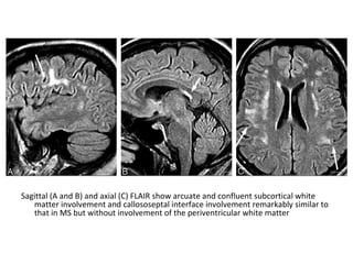 Diagnostic Imaging of Central Nervous System Infections | PPT