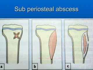 Orthopaedic INFECTION post operative surgical site | PPT