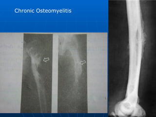 Orthopaedic INFECTION post operative surgical site | PPT