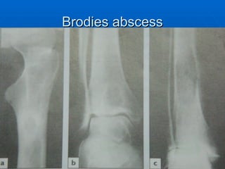 Orthopaedic INFECTION post operative surgical site | PPT
