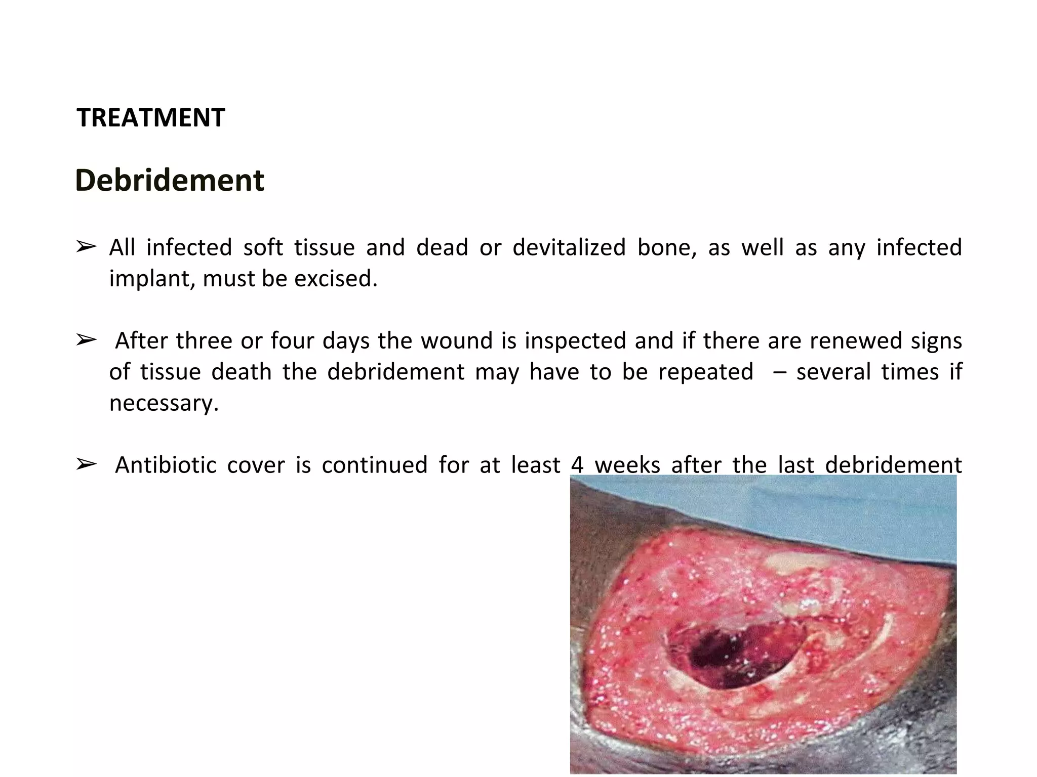 Chronic Osteomyelitis | PPTX