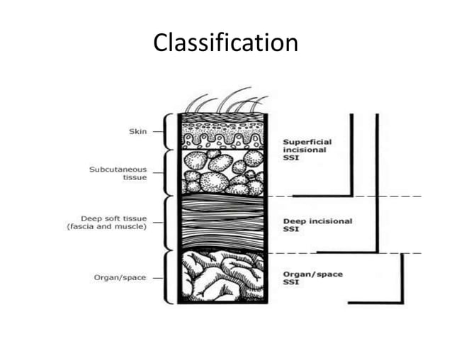 Infection control and surgical wound complications (1) (1) | PPT