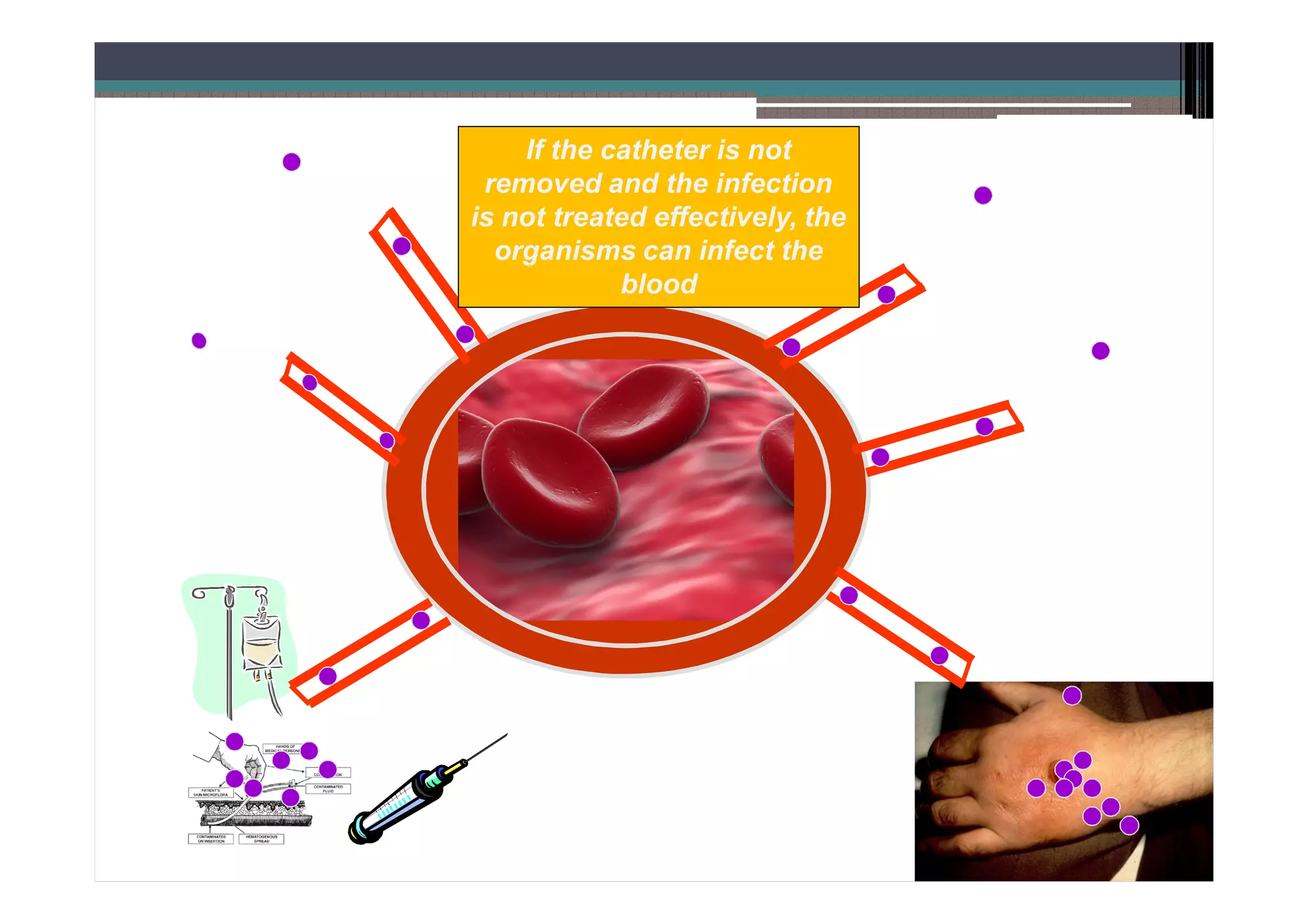 Infection control guidelines for Prevention of Peripheral Venous ...